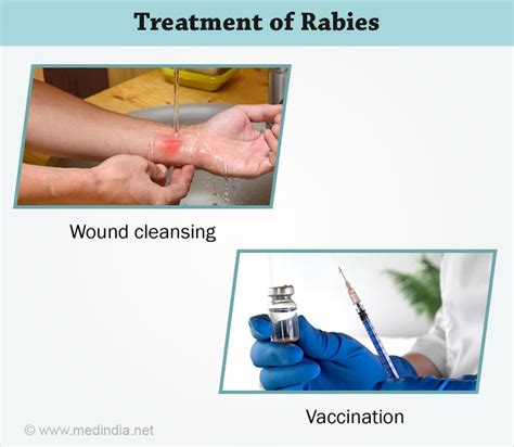 Rabies Types Causes Symptoms Diagnosis Treatment And Prevention