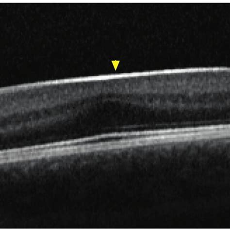 Epiretinal Membrane Erm Foveal Oct Cross Sectional B Scan In An Eye Download Scientific