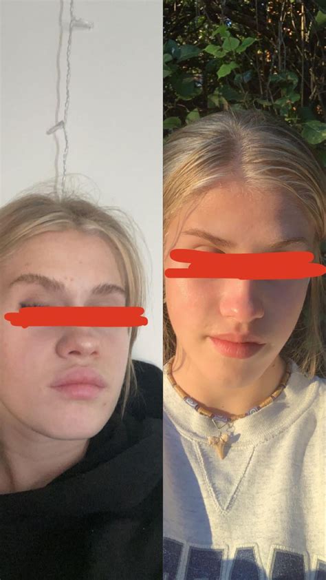 Post Djs Week 10 R Jawsurgery