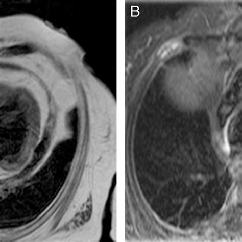 A Cardiovascular Magnetic Resonance Imaging T2 Turbo Spin Echo Download Scientific Diagram