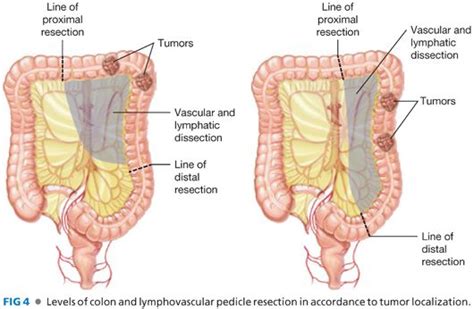 Left Colectomy For Colon Cancer Abdominal Key