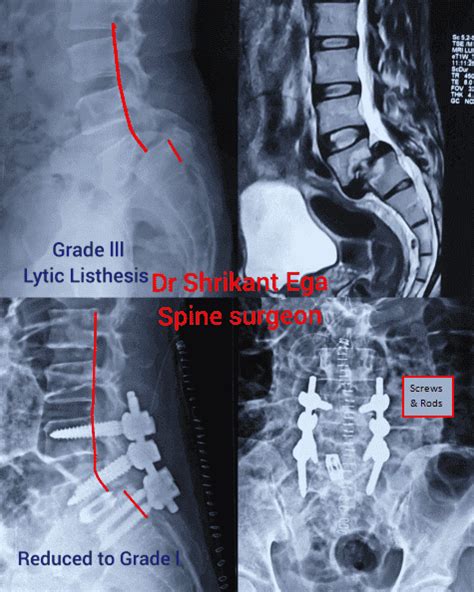 Lumbar Instrumented Fusion Spine Sure Clinic