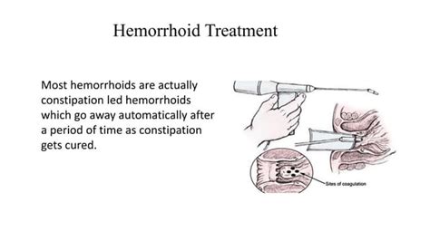 Hemorrhoid Treatment 10 Types Of Hemorrhoid Medical Treatment Pptx