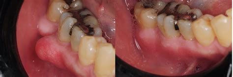 Jaw Bone Torus Or Exostosis Bony Protrusions Diagnosis And Treatment