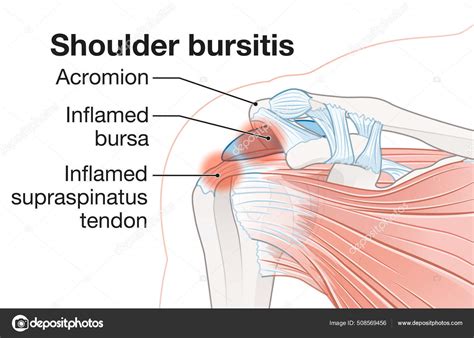 Bahu Bursitis Bursa Terbakar Dan Tendon Supraspinatus — Foto Stok
