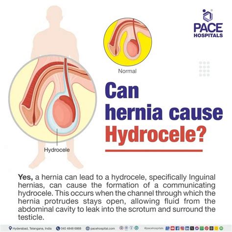 Pace Hospitals On Linkedin Hydrocele Hydroceleawareness