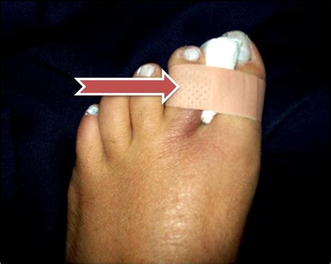 What Does A Broken Toe Look Like At Fred Rollins Blog