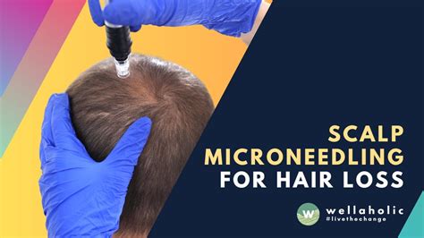Regrow Your Hair With Scalp Microneedling The Permanent Solution To Hair Loss Wellaholic