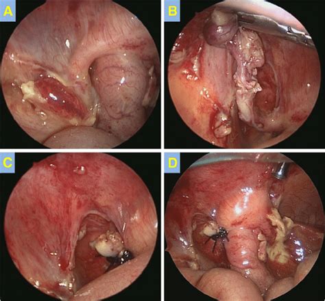 Ruptured Appendix Abscess