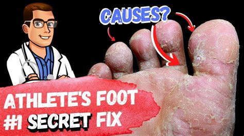 Toenail Fungus And Athletes Foot Treatment At Carole Spears Blog
