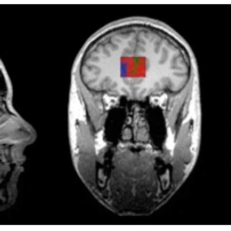 An Example Of Tissue Segmentation At Individual Space To Segment Grey Download Scientific