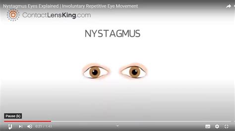 Nystagmus 2 Video Explained Youtube