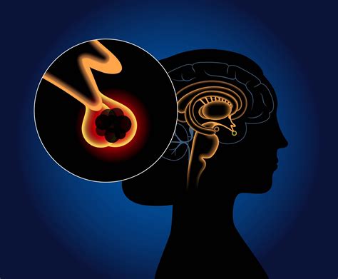 Pituitary Tumor Treatment In Turkey Online Consultation