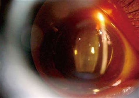 Slit Lamp View Of Microspherophakia In A Patient With Weill Marchesani Download Scientific