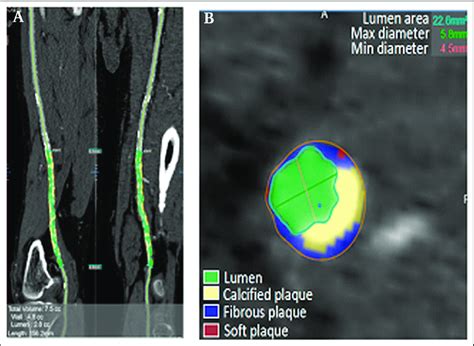 Ct Plaque Tissue Composition Analysis Of Femoral Artery Plaque A Cta Download Scientific