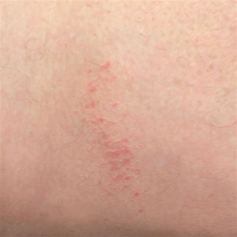 Linear Lichen Online Consultation Ai Dermatologist