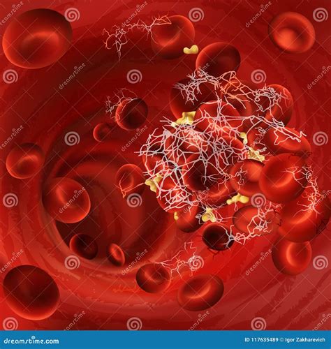 Vector Illustration Of A Blood Clot Thrombus Or Embolus With