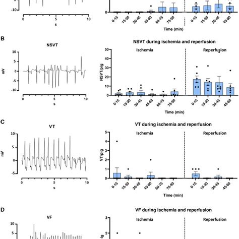 Electrocardiogram Ecg Examples And Temporal Arrhythmia Incidence In Download Scientific