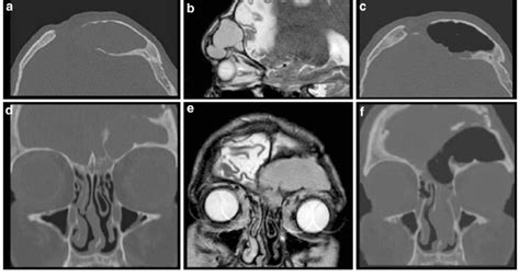 Lateral Mucocele Invading Anterior Cranial Fossa Pre And Download Scientific Diagram