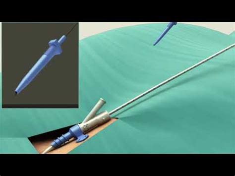 Guide Wire At Best Price In India