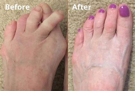 Hyggear™ Hammer Toe Straighteners Hyggear