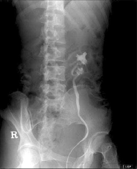Retrograde Pyelography Rgp Of The Lower Ureter Download Scientific