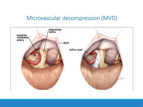 Trigeminal Neuralgia Dr Dilip Kumar Macharlapptx