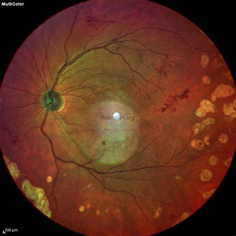 Multimodal Imaging Of Retinal Neovascularization Secondary To
