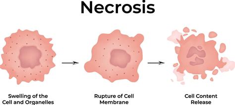 Necrosis Cancer Development Normal Cell Cancer Cell Illustration