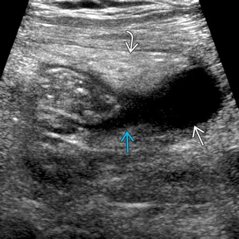 Diverticulitis Radiology Key