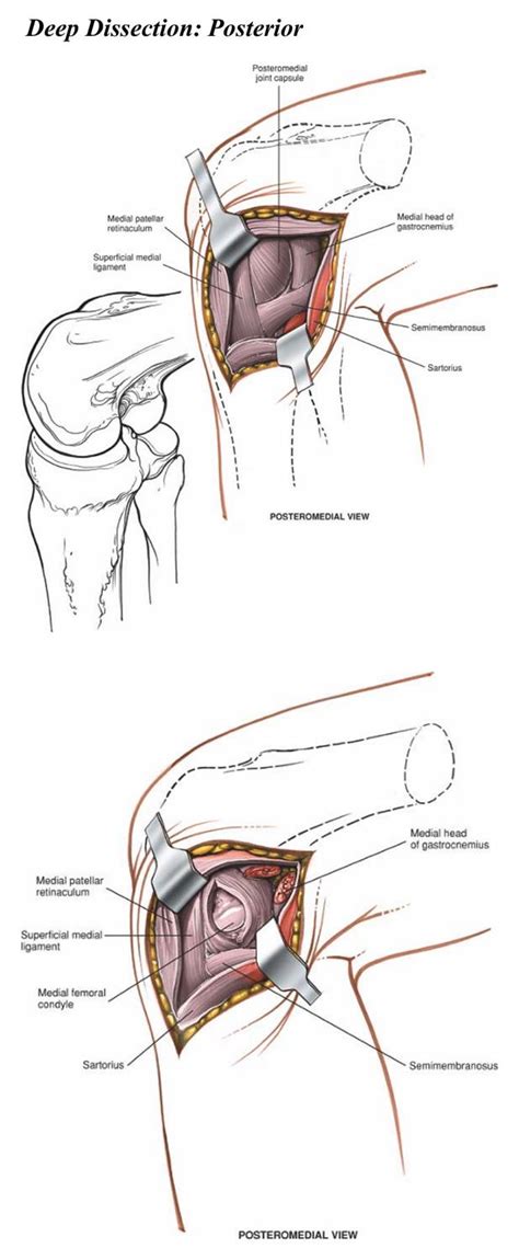 Knee Medial Approach Approaches Orthobullets