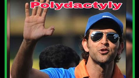 Polydactyly Types Of Polydactyly Preaxial Central And Postaxial