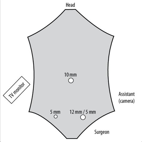 Port Placement For Laparoscopic Appendectomy Download Scientific Diagram