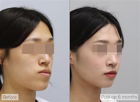 양악수술 사각턱 앞턱