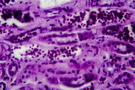 Diffuse Proliferative Glomerulonephritis Stock Image Image Of Illness