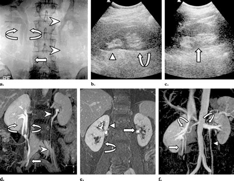 Intravenous Urographic Us And Mr Imaging Findings In Duplication Of Download Scientific