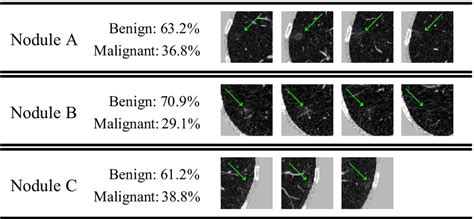Some Malignant Ground Glass Opacity Nodules That Are Misclassified As Download Scientific