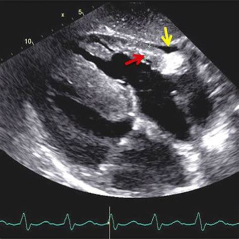 Speckle Tracking Global Longitudinal Strain In A Patient With Attr Download Scientific Diagram