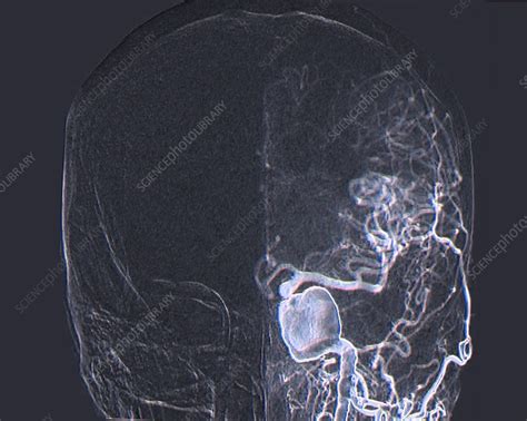 Brain Aneurysm Angiogram Stock Image C0480279 Science Photo Library
