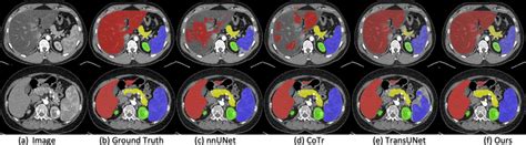 Segmentation Examples Of Different Methods On Abdomenct 1k Fully