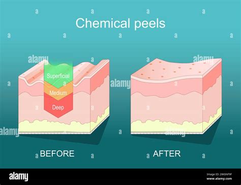 Chemical Peel Beauty Aesthetic Treatment Deep Medium Superficial