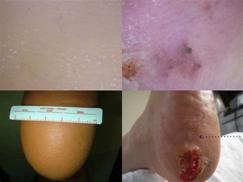 Vascularized Parallel Ridge Pattern Vprp Acral Lentiginous Melanoma Download Scientific