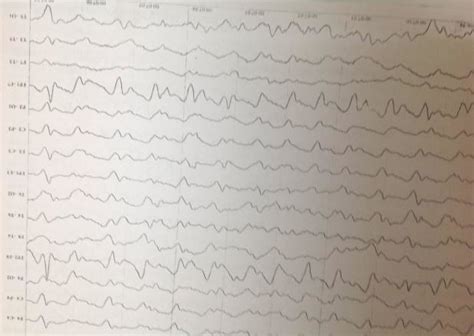 Eeg Showing Periodic Triphasic Sharp Waves Download Scientific Diagram