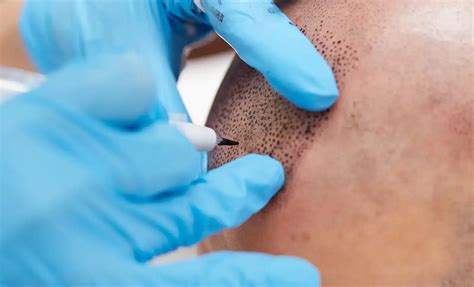 Understanding The Benefits And Process Of Scalp Micropigmentation