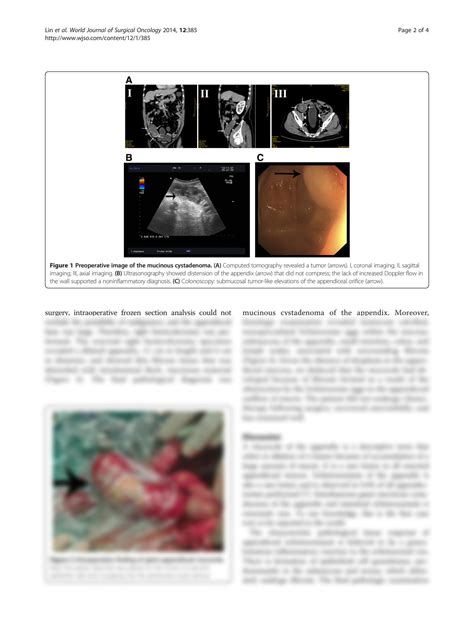 Solution Simultaneous Giant Mucinous Cystadenoma Of The Appendix And Intestinal Schistosomiasis