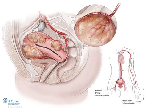 Complications Of Uterine Artery Embolization Uterine Fibroid