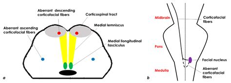 Midbrain Mlf Fasciculus Colliculus Nucleus Inferior Medial Cranial