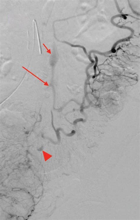 Mesenteric Angiogram Demonstrates Subselection Of The Ima In Order Of Download Scientific