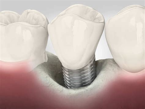 Peri Implantitis