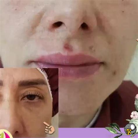 رفع گودی و کبودی زیر چشم فیلو